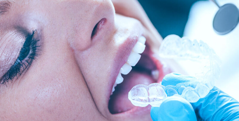 Onzichtbare beugels van Invisalign en Spark Aligners | De Tandarts